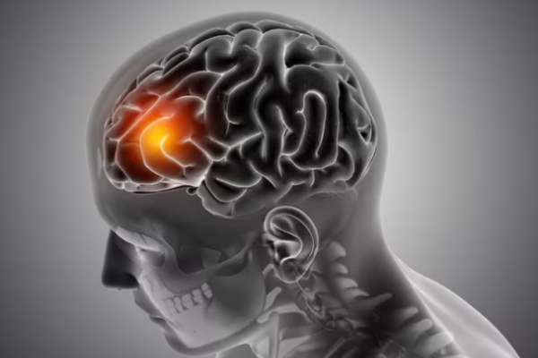 Salud cerebral y ACV: cómo prevenir la patología que afecta a 1 de cada 4 personas | Nuevo ...