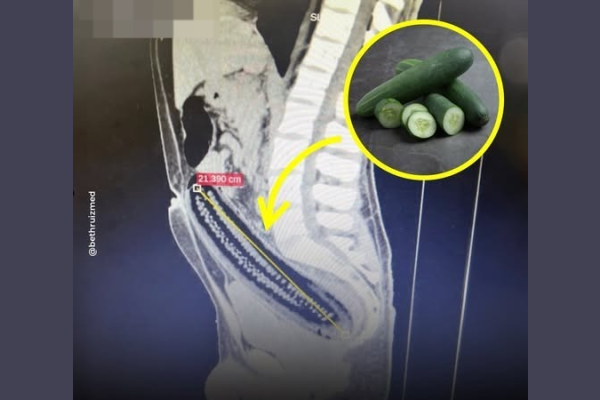 Insólito caso médico: detectaron un pepino de 21 centímetros en el ...